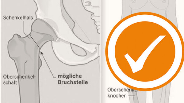 Knochen: Eine Dauerbaustelle im Körper | Apotheken Umschau